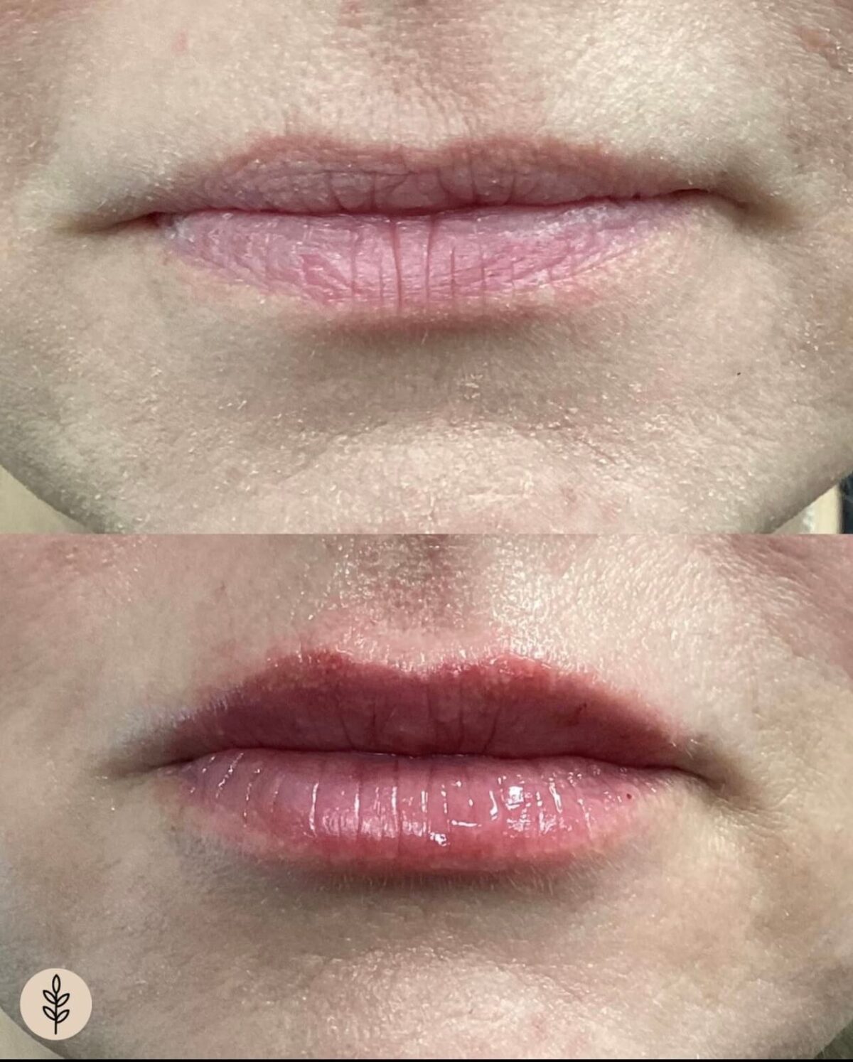 Before And After Lip Injections, Montville NJ- Montville Med