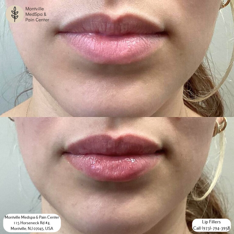 How to Get That Defined Look: Strong Cupid’s Bow Lip Filler Techniques