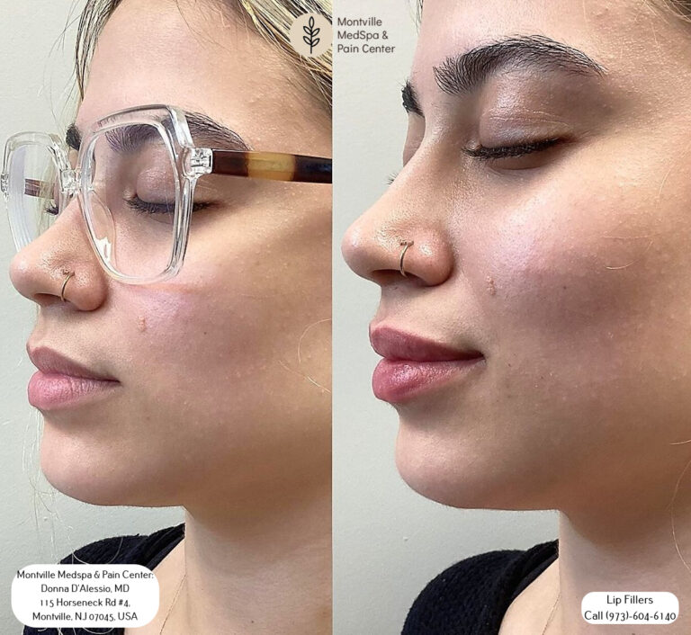 Swelling and Bruising After Lip Fillers? Here’s What to Expect (and How ...