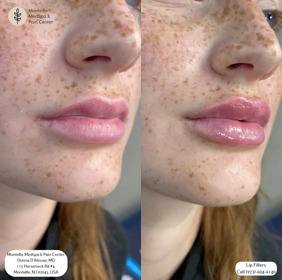 Aching for Answers: Do Lip Fillers Hurt?