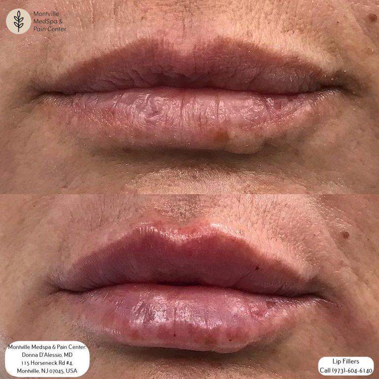 Lip Fillers Gone Wrong: What To Do After A Botched Treatment