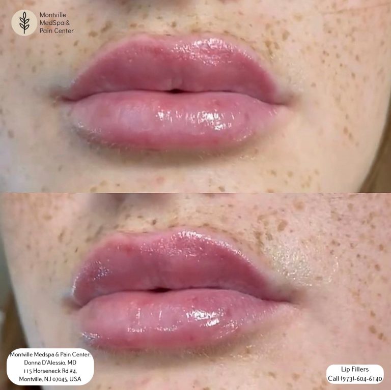 Lip Filler Swelling Stages: The Day-by-Day Rundown