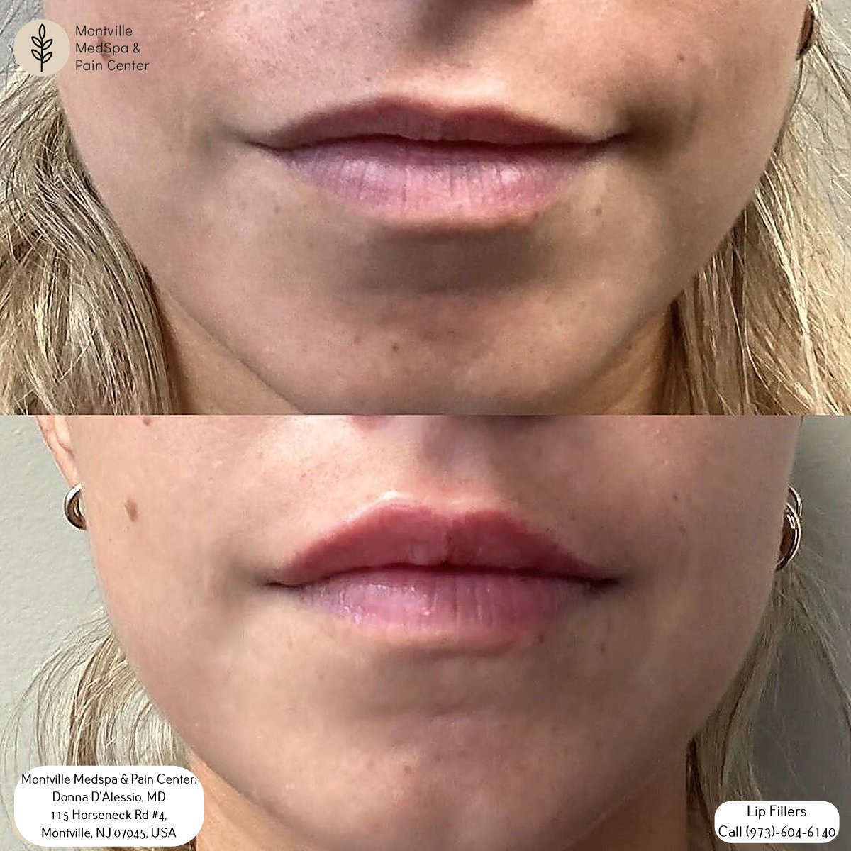 The Secret to Perfectly Pouty Lips: Russian Lip Filler Revealed