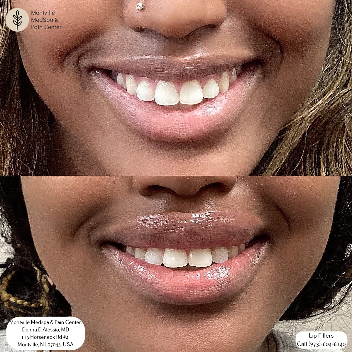 The Complete Guide to Lip Filler Removal