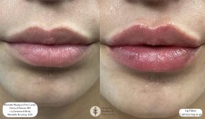 The Role of Dental Blocks for Lip Filler Procedures