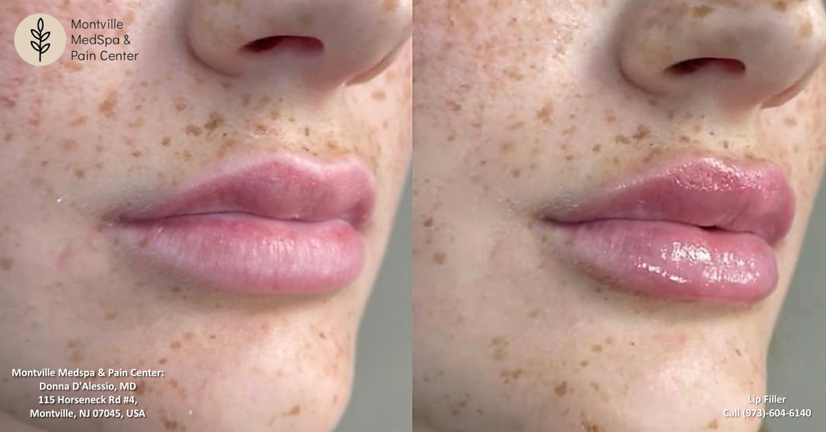 When Can I Use a Straw After Lip Filler?