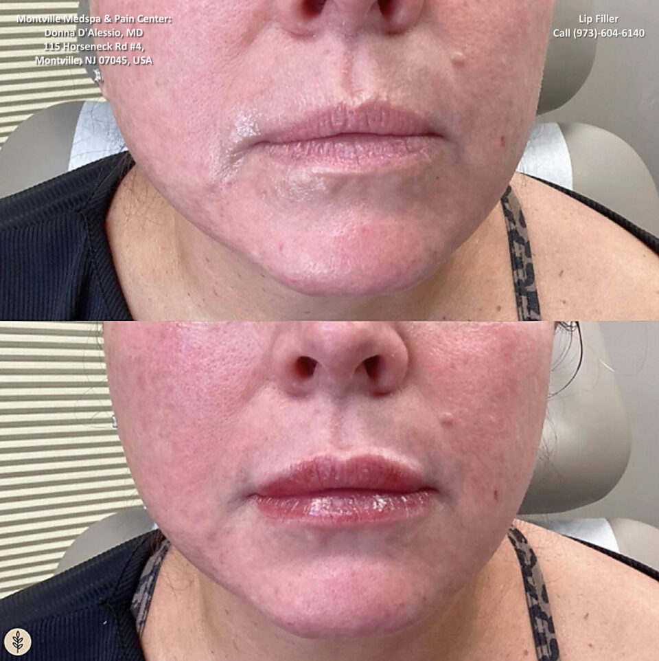 How to Sleep After Lip Fillers